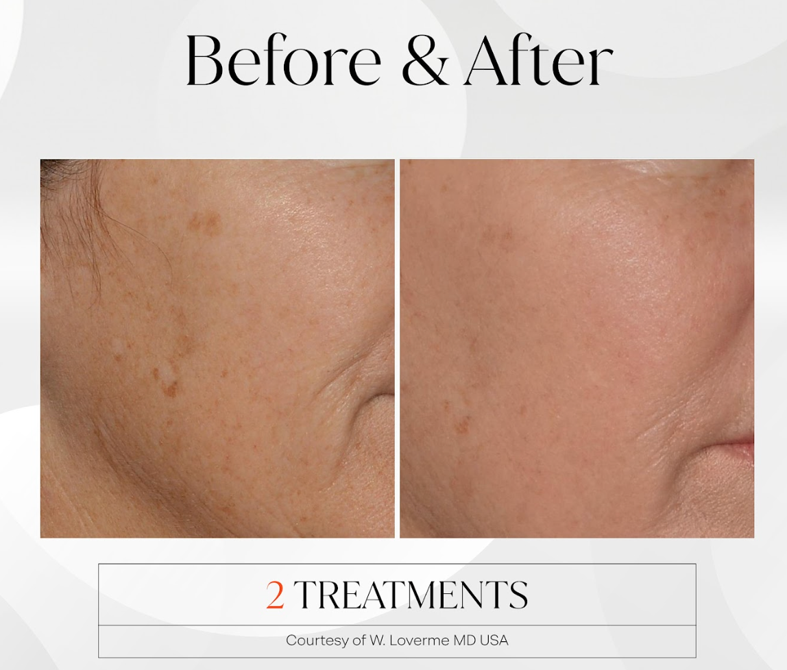 Fusion Treatment – Arch Aesthetics Clinic